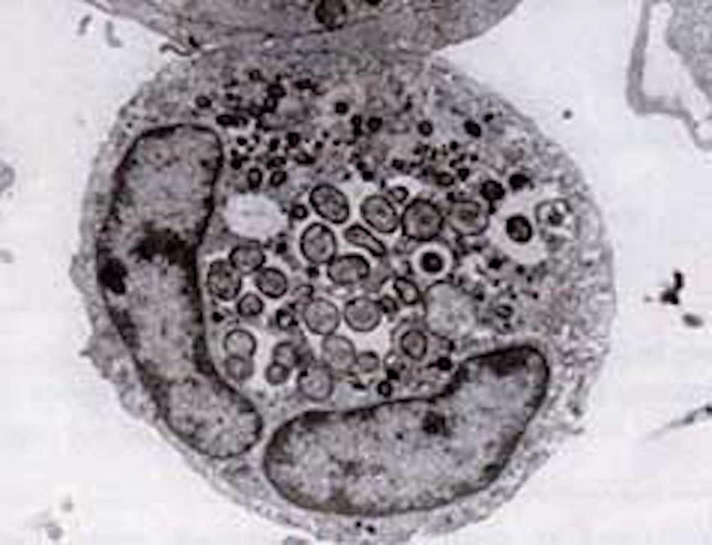Anaplasmosis | Lyme Disease