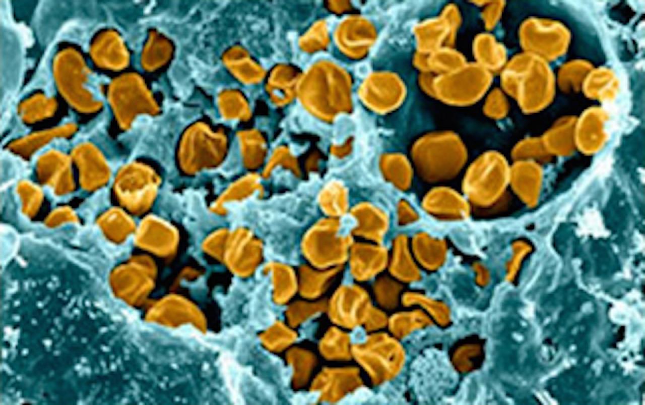 Tularemia | Lyme Disease