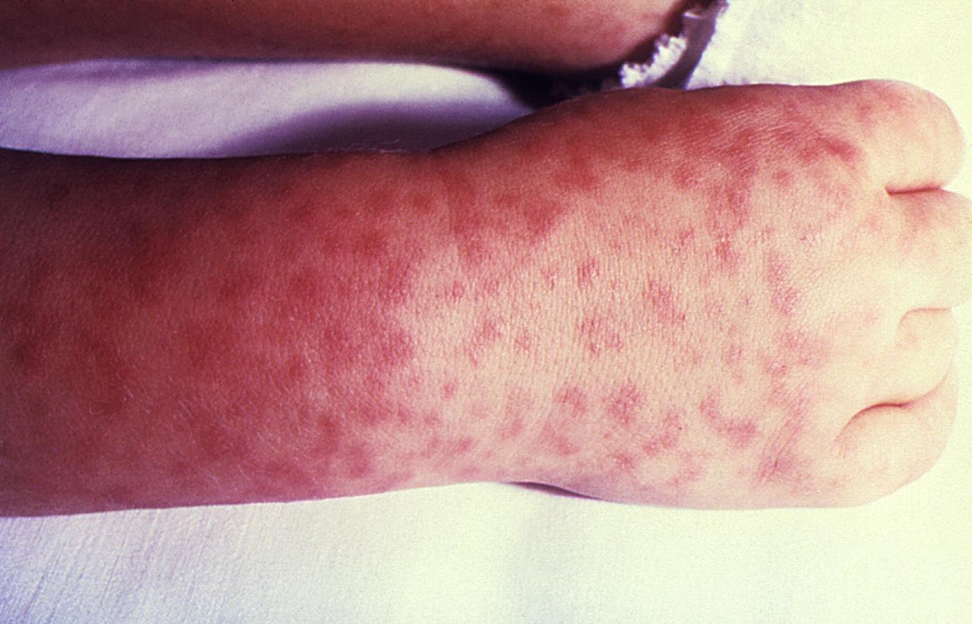 Rocky Mountain Spotted Fever Lyme Disease Rocky Mountain Spotted Fever Lyme Disease