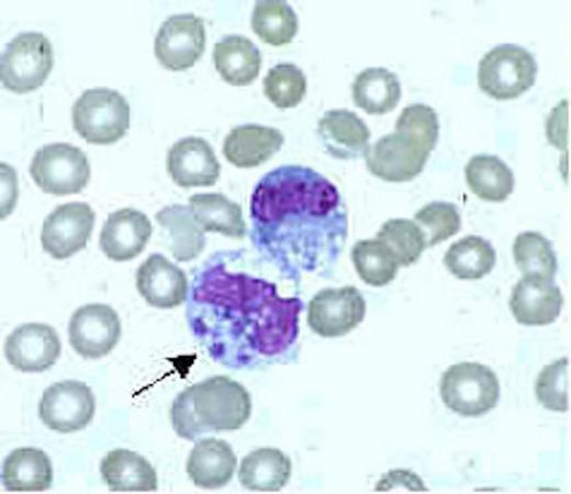 Ehrlichiosis | Lyme Disease