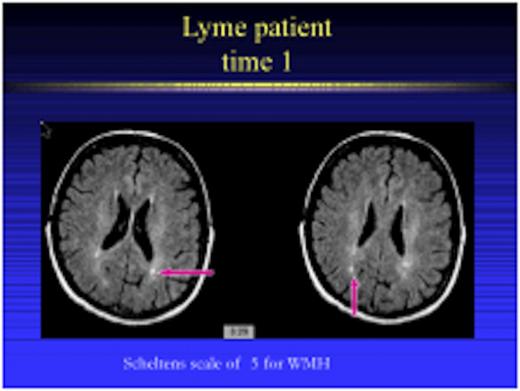 Diagnosis | Lyme Disease